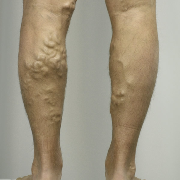 Varicose Veins Causes And Treatment